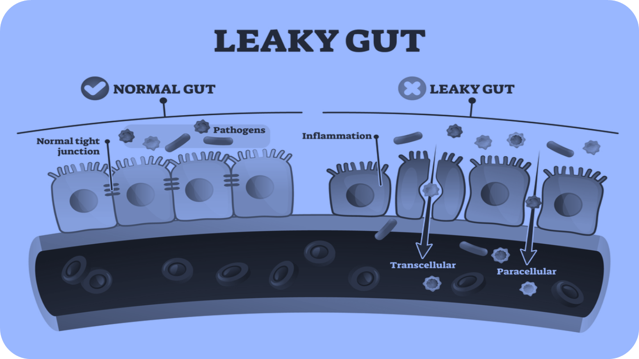 Leaky Gut and Its Nutritional Treatment: A Comprehensive Guide – Mercy ...